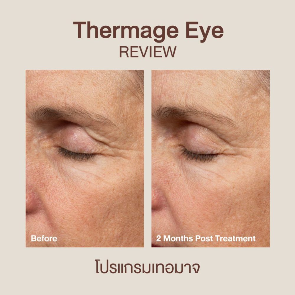 เจาะลึก Thermage Eye เทคโนโลยียกกระชับหนังตา ไม่ผ่าตัดไม่พักฟื้น - DSK ...